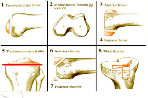 Total Knee Replacement Surgery: Procedure and Recovery | Meril Life